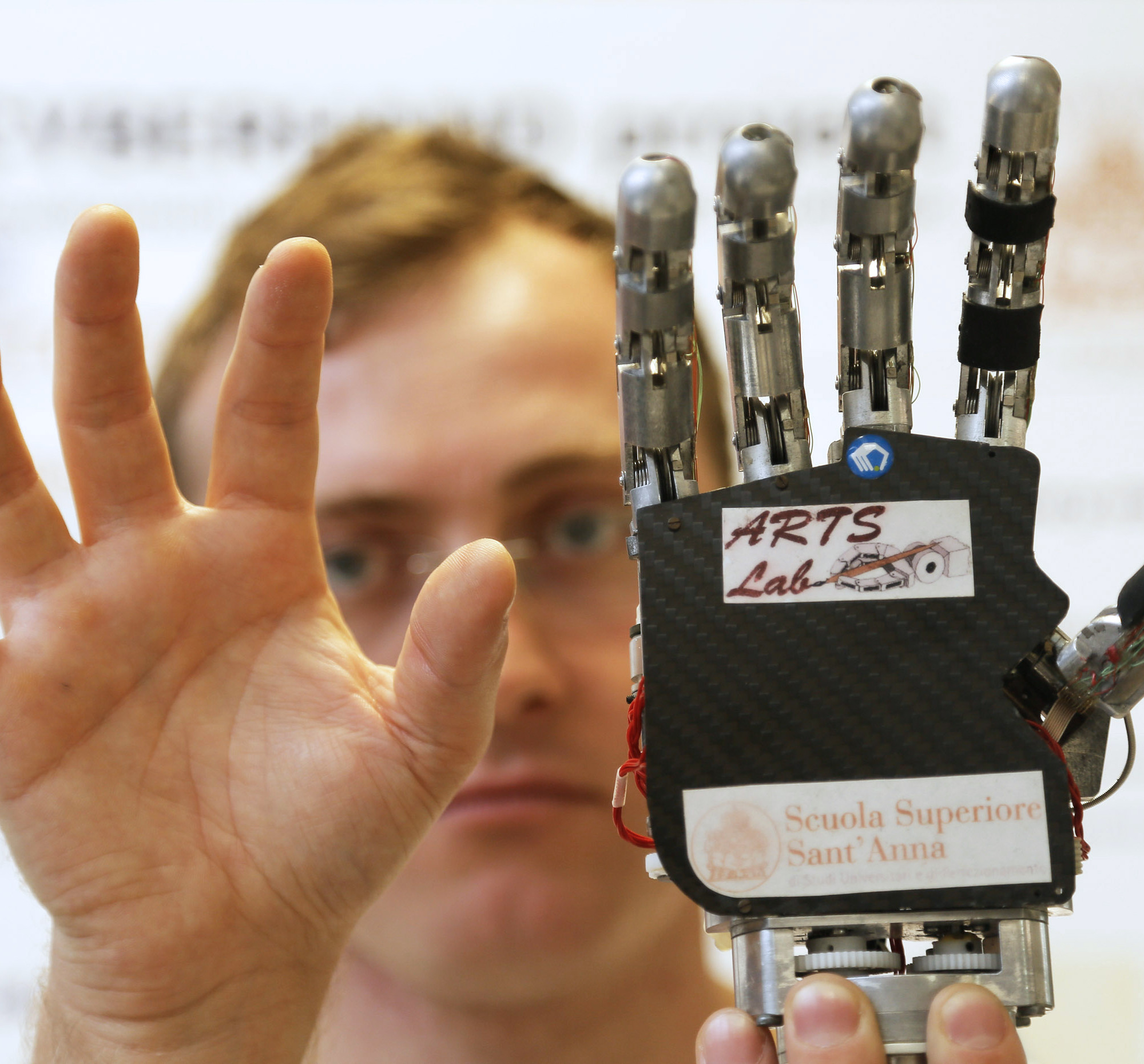 Amputé, il a fabriqué une main bionique à partir de plans sur internet